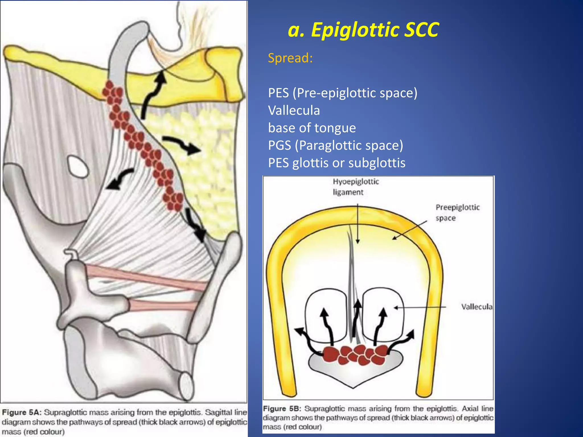 Larynx anatomy and laryngeal ca | PPTX