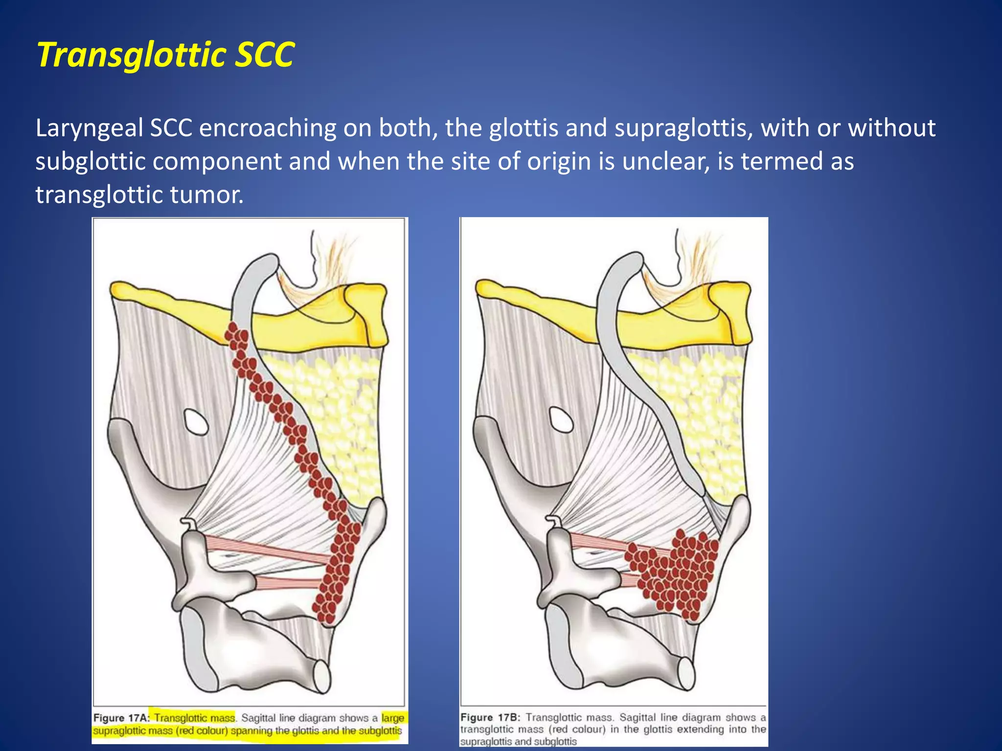 Larynx anatomy and laryngeal ca | PPTX