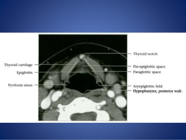Larynx anatomy and laryngeal ca