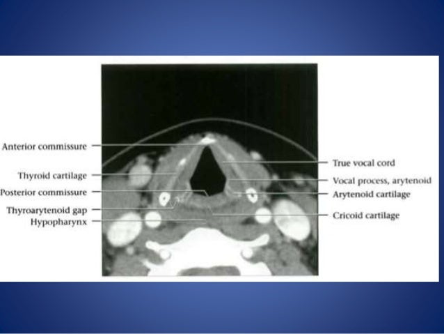 Larynx anatomy and laryngeal ca