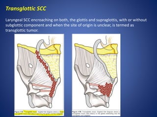 Larynx anatomy and laryngeal carcinoma | PPT