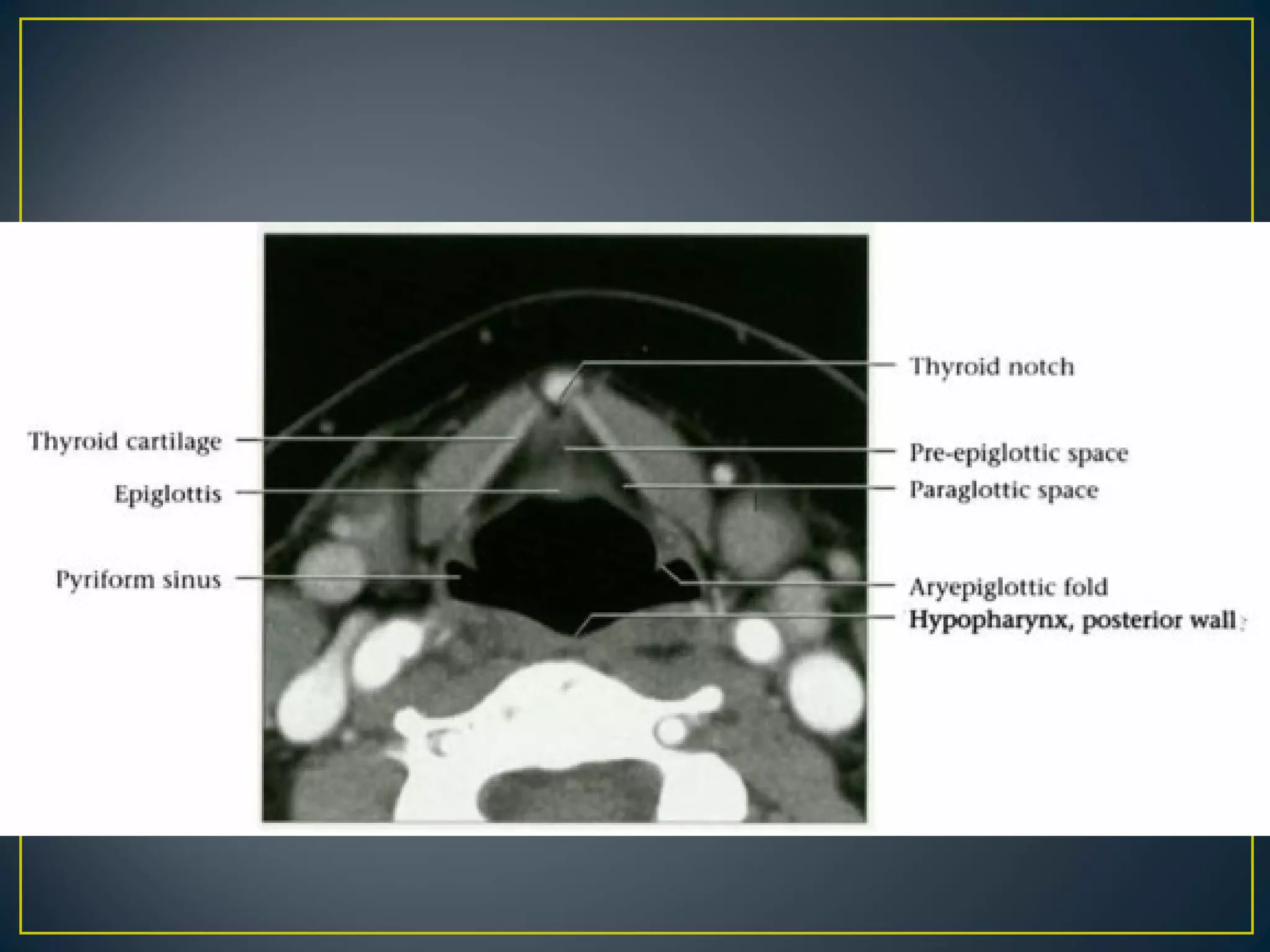 Larynx anatomy ct and mri | PPT