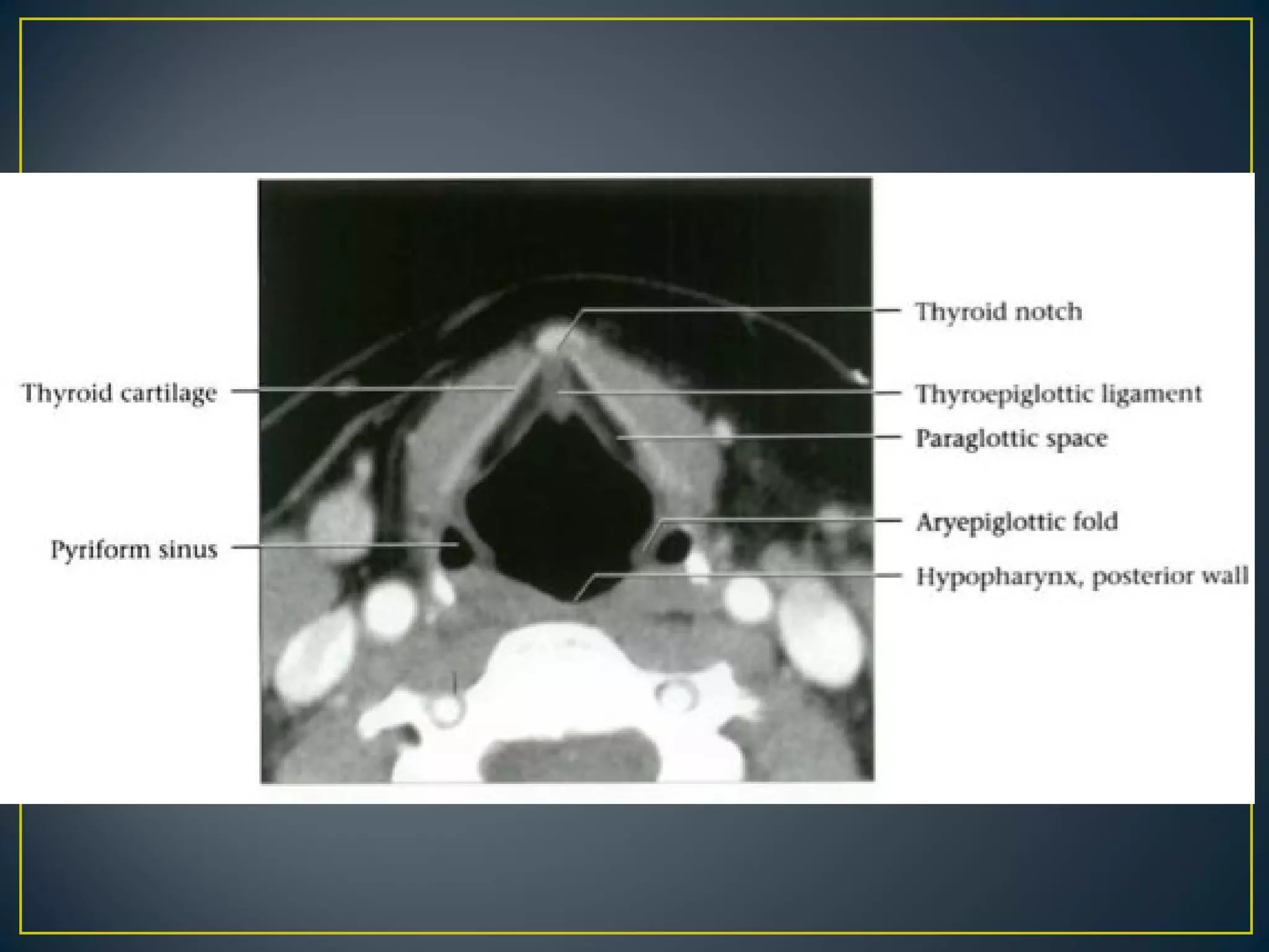 Larynx anatomy ct and mri | PPT