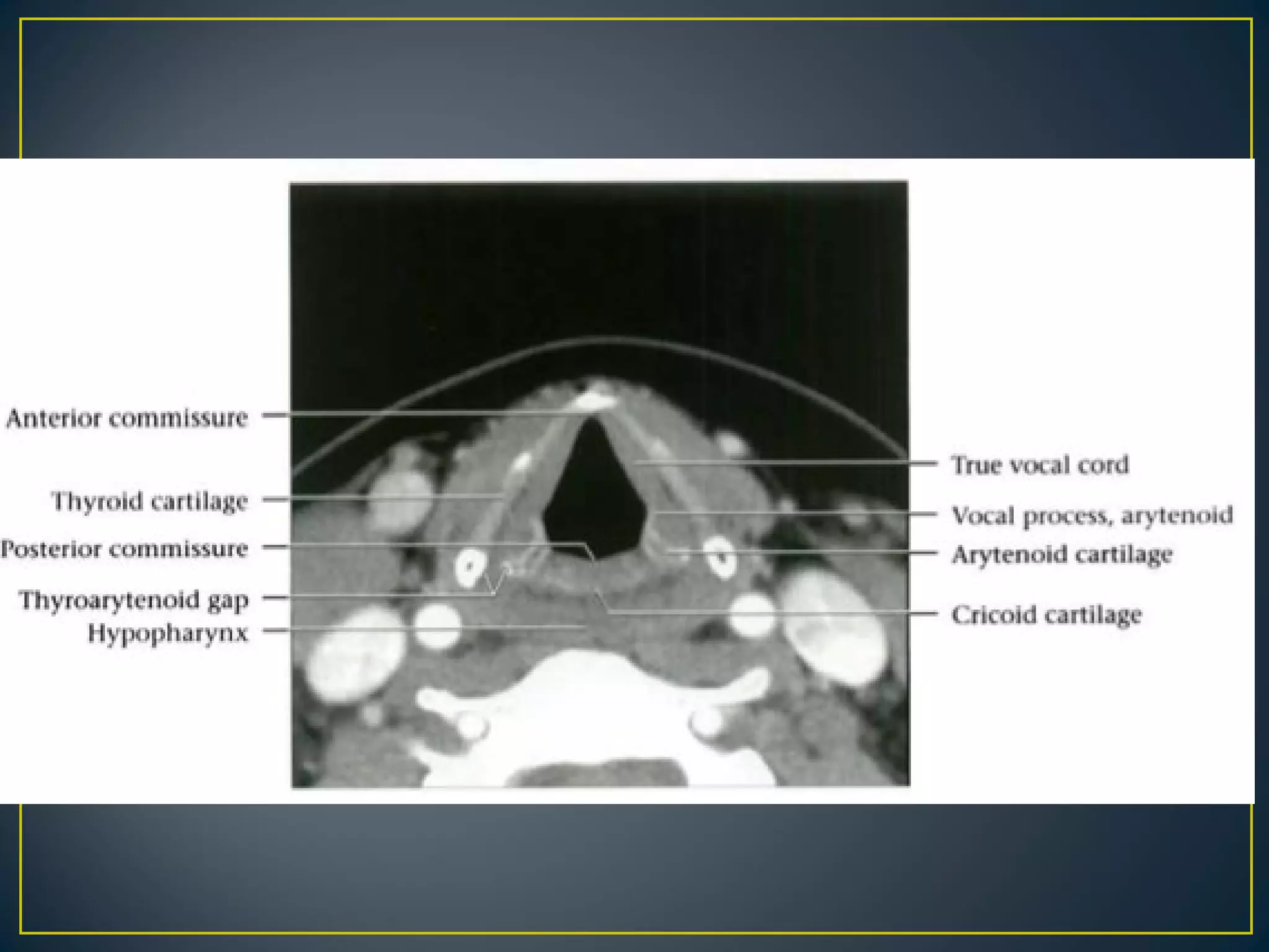 Larynx anatomy ct and mri | PPT