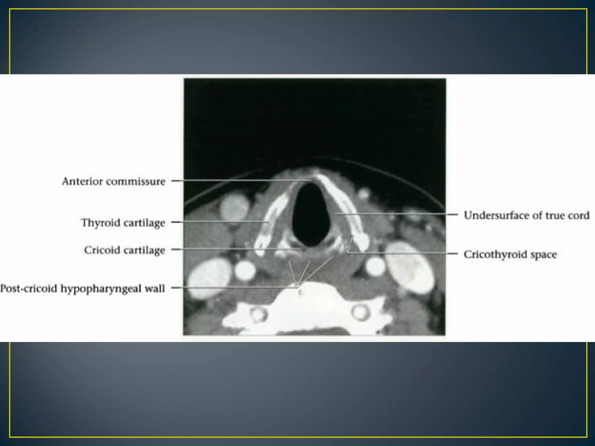 Larynx anatomy ct and mri | PPT
