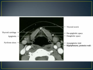 Aryepiglottic Fold Xray