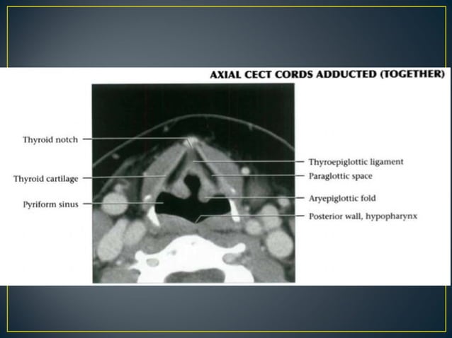 Larynx anatomy ct and mri