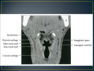 Larynx anatomy ct and mri | PPT