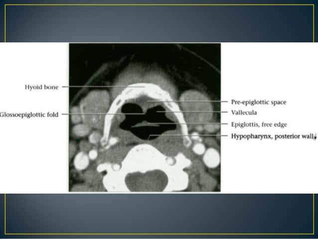 Larynx anatomy ct and mri
