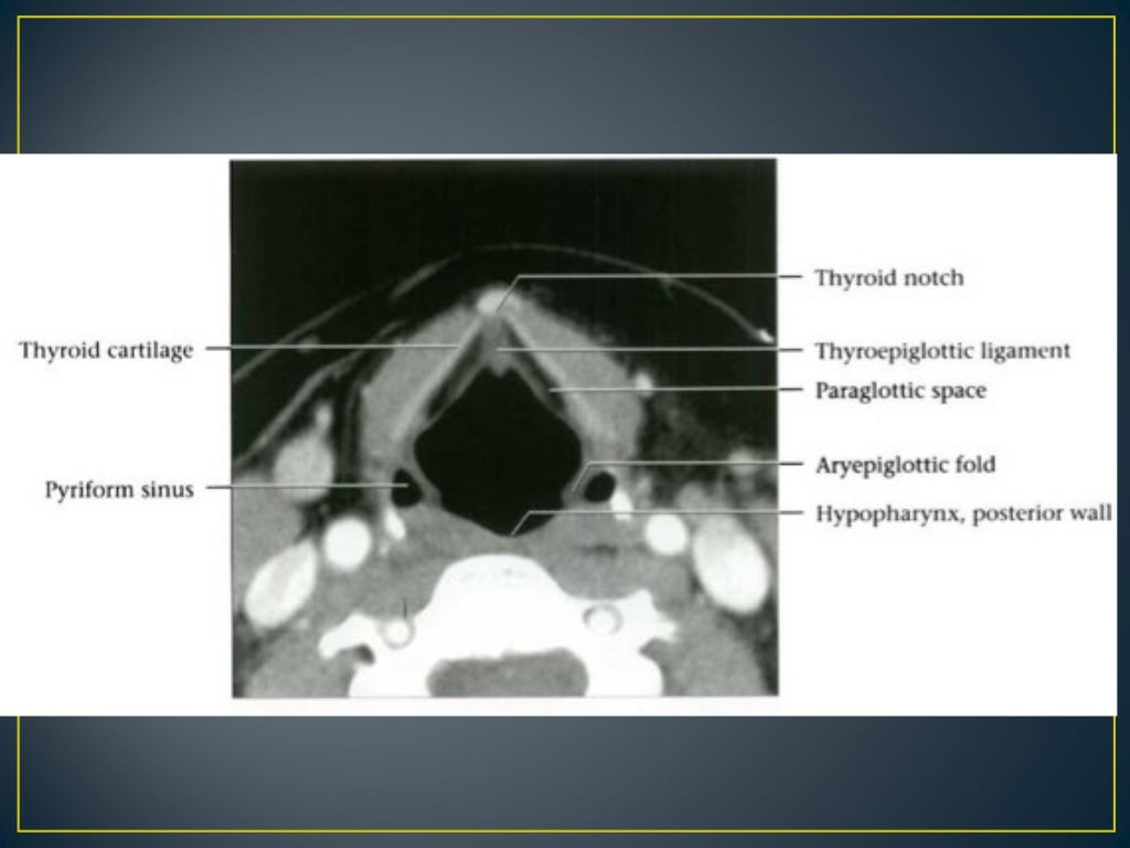 Larynx anatomy ct and mri