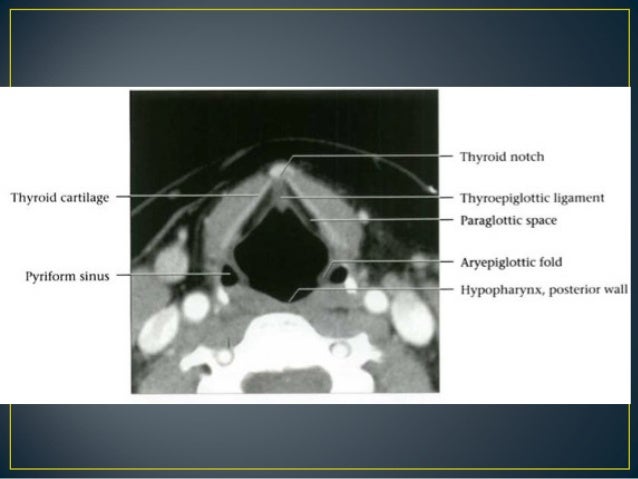 Larynx anatomy ct and mri