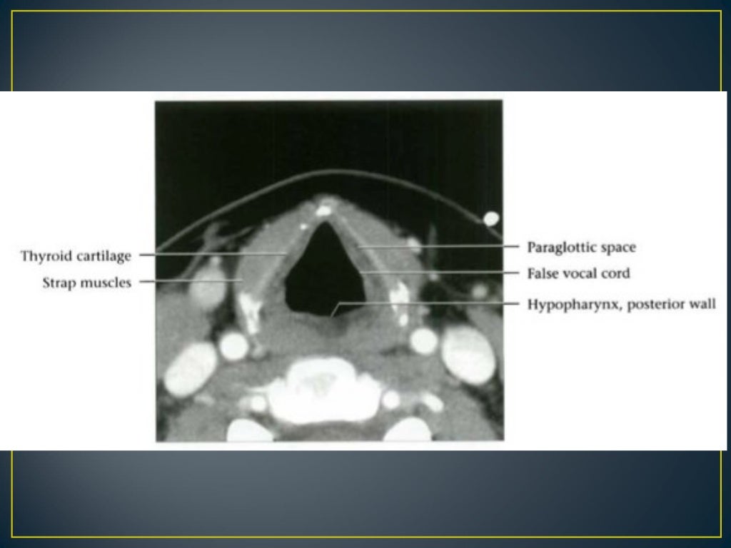 Larynx anatomy ct and mri