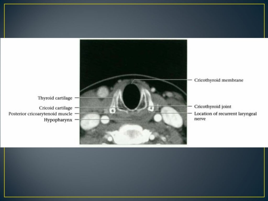 Larynx anatomy ct and mri