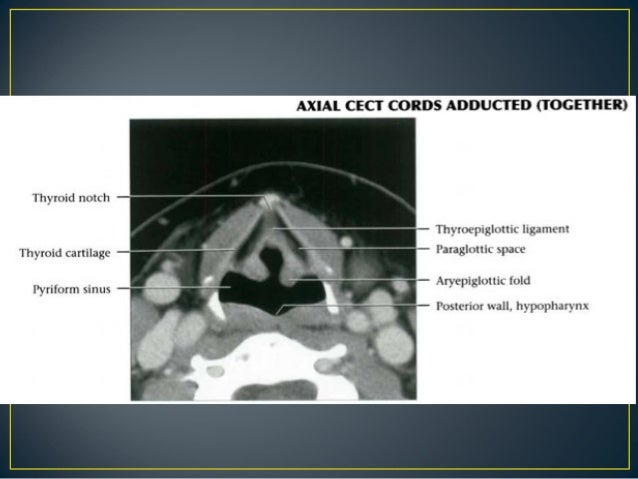 Larynx anatomy ct and mri