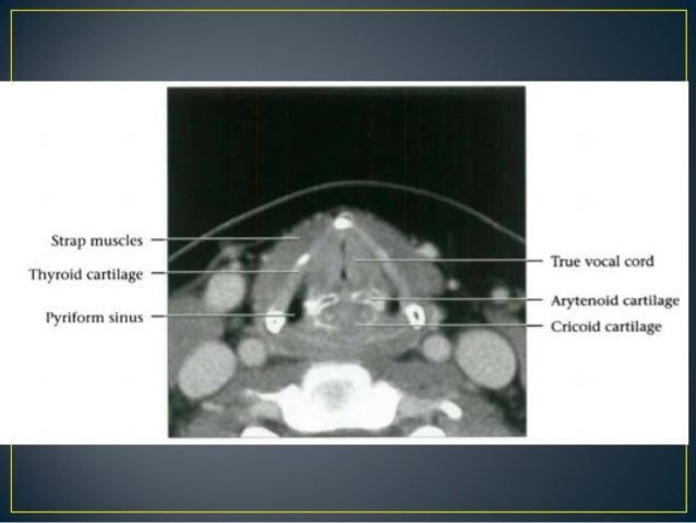 Larynx anatomy ct and mri