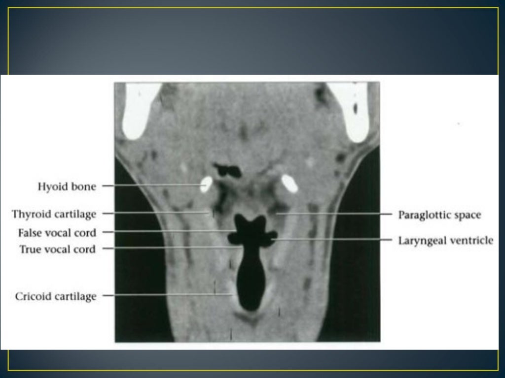 Larynx anatomy ct and mri