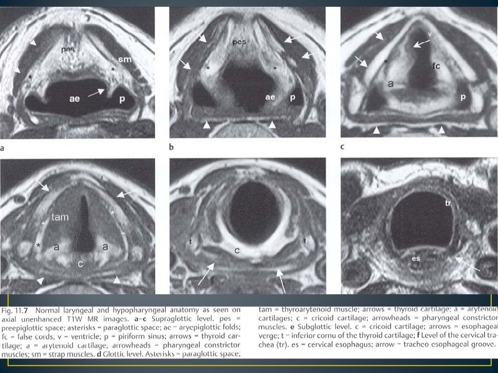 Larynx anatomy ct and mri