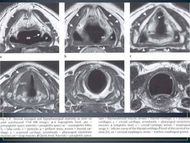 Larynx anatomy ct and mri
