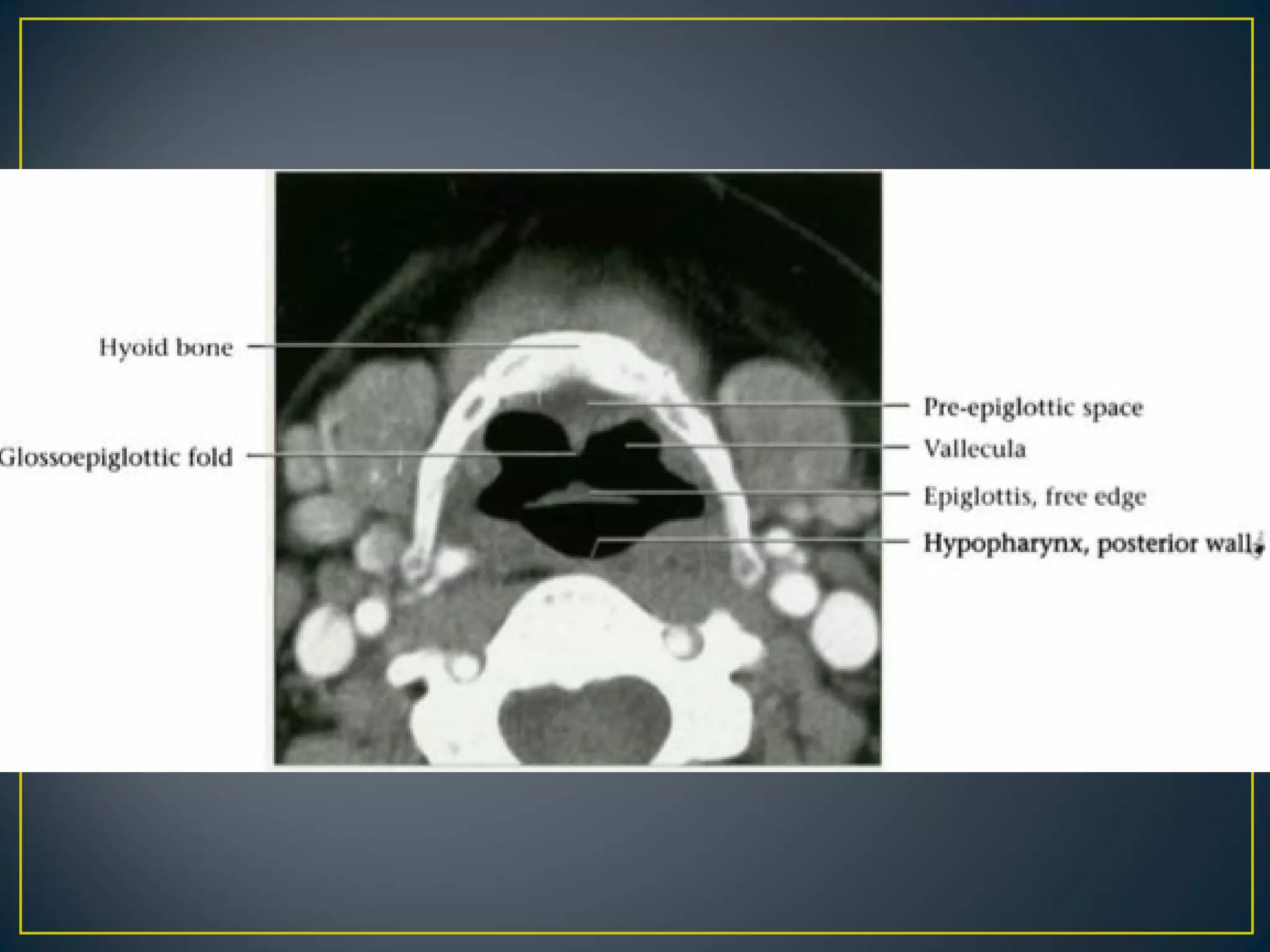 Larynx anatomy CT and MRI | PPT