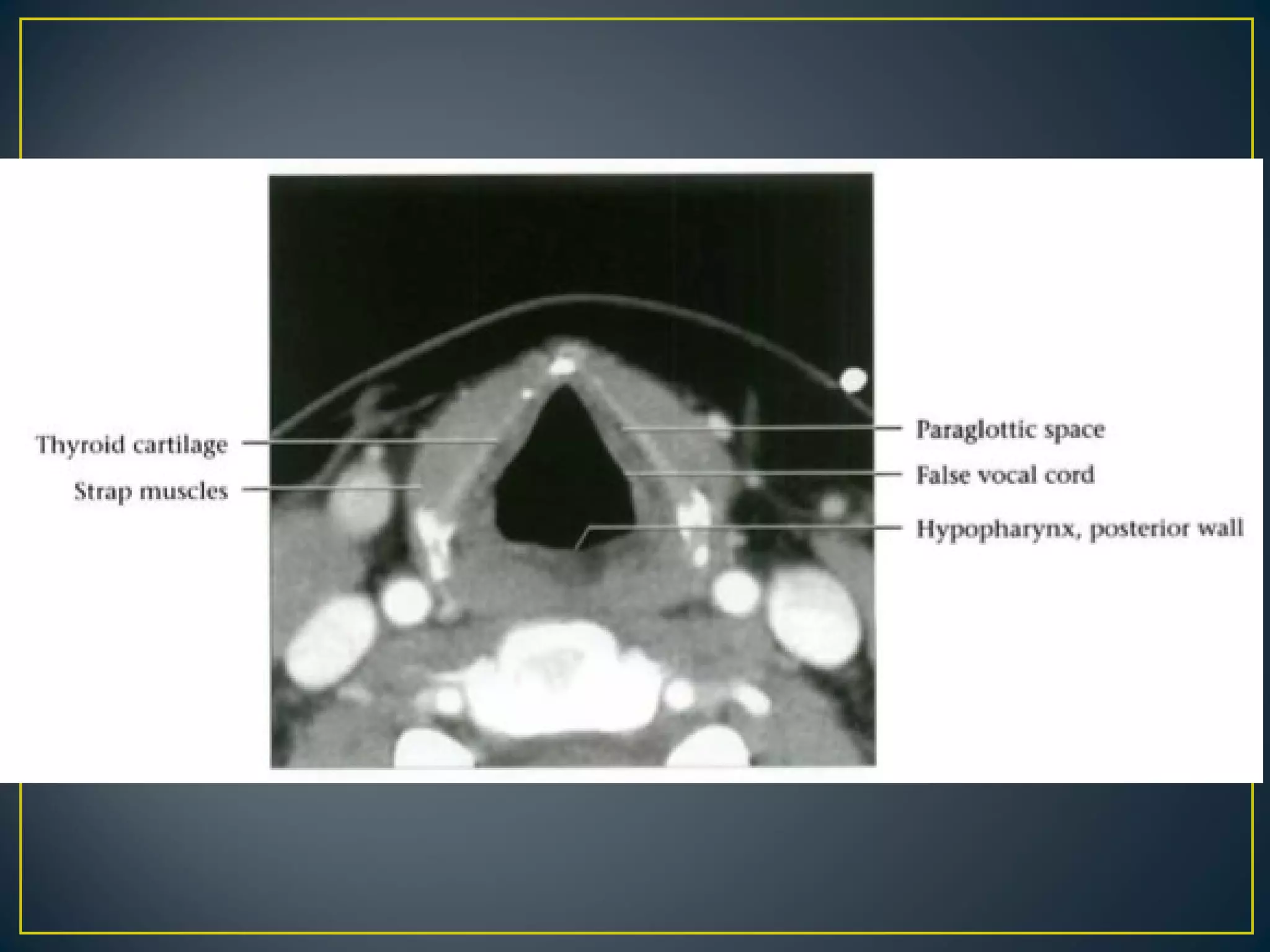 Larynx anatomy CT and MRI | PPT