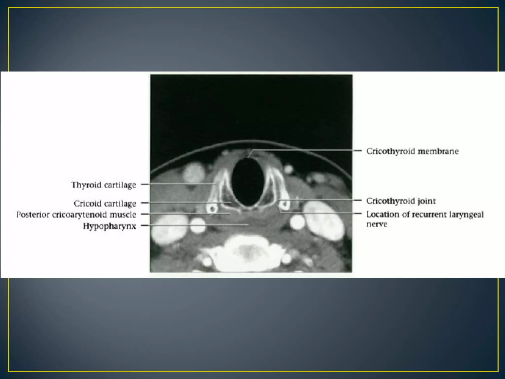 Larynx anatomy CT and MRI | PPT