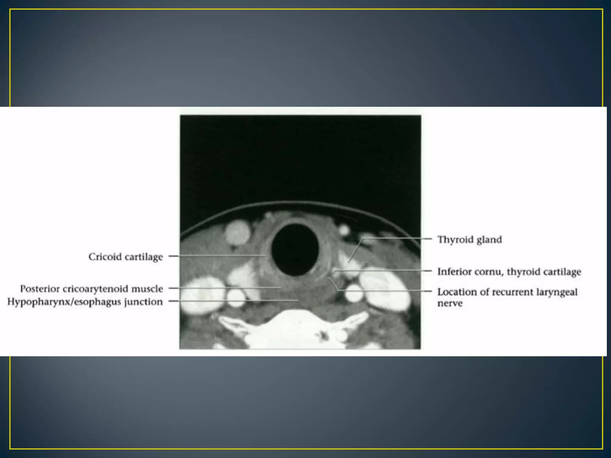 Larynx anatomy CT and MRI | PPT