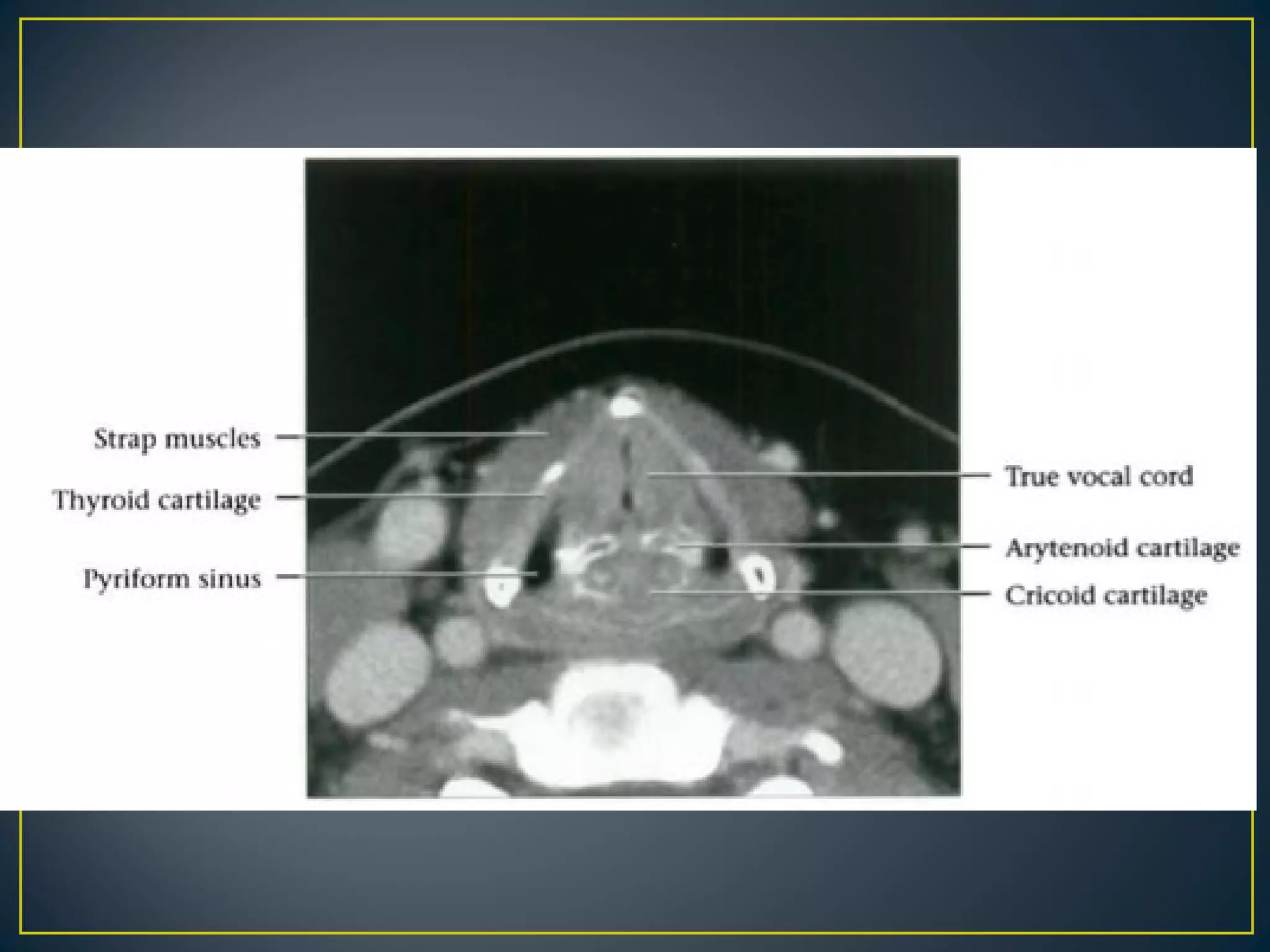 Larynx anatomy CT and MRI | PPT