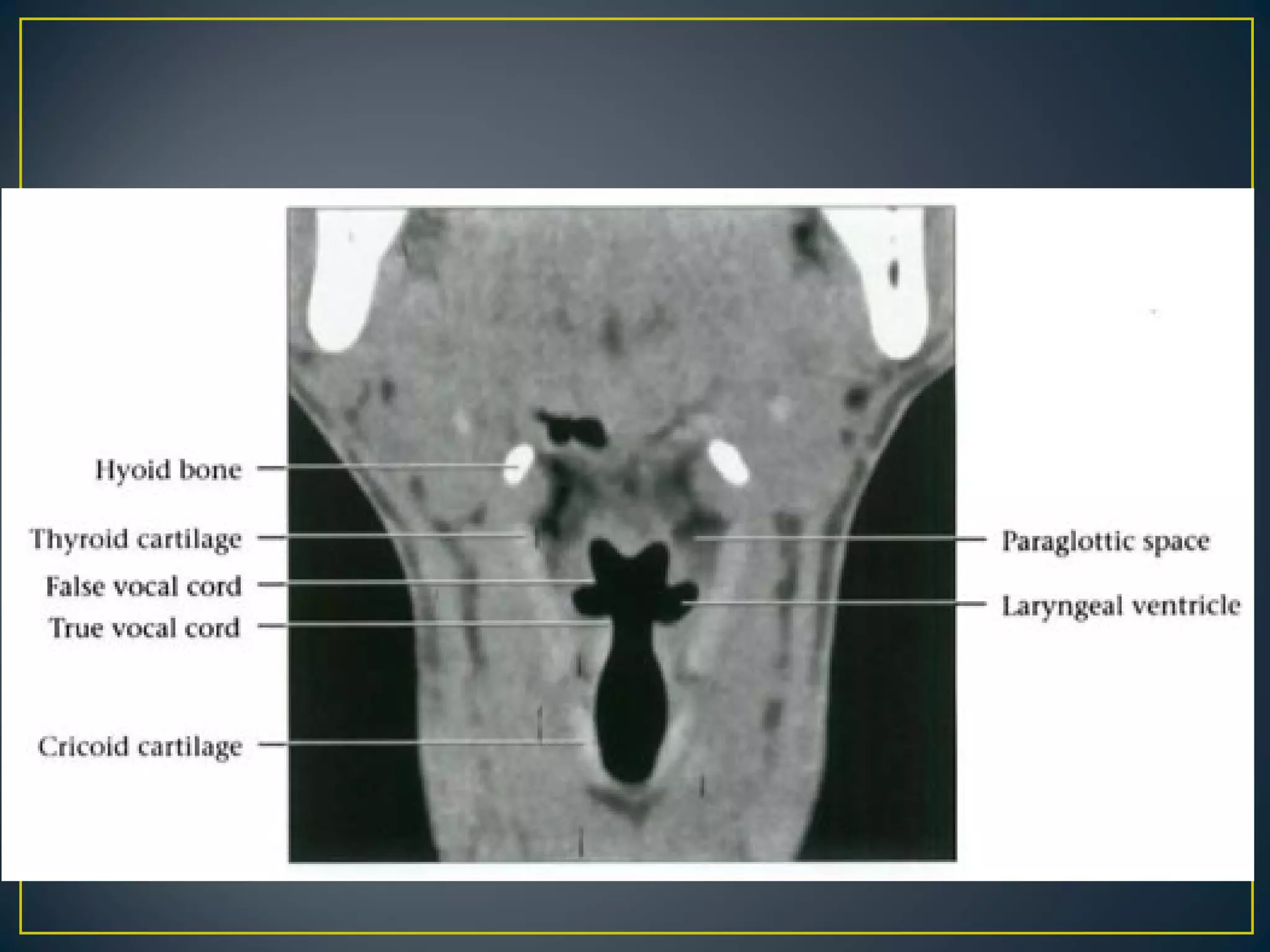 Larynx anatomy CT and MRI | PPT