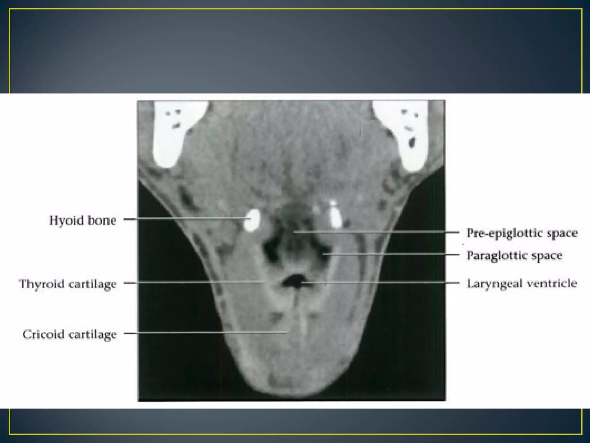 Larynx anatomy CT and MRI | PPT