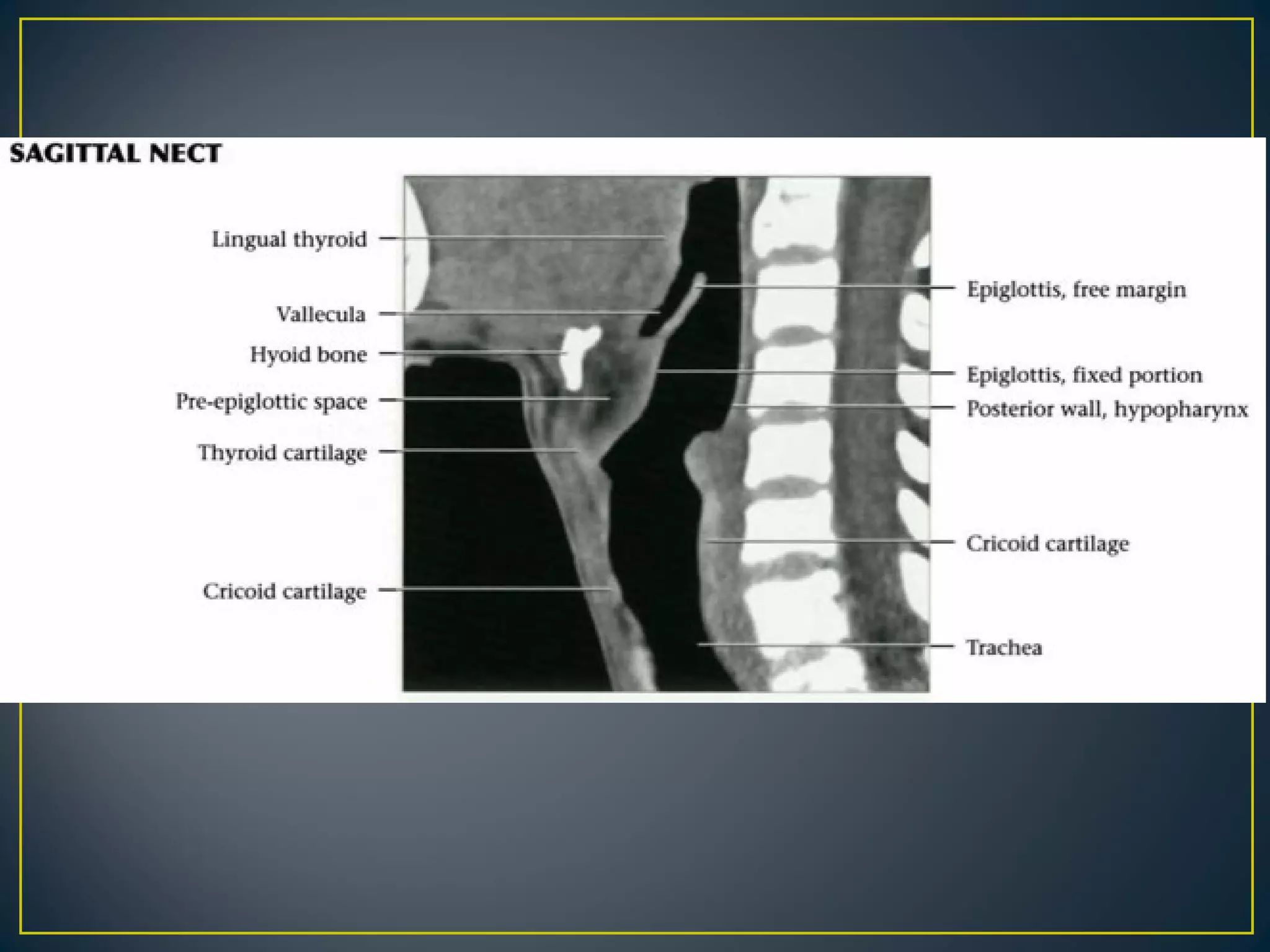 Larynx anatomy CT and MRI | PPT