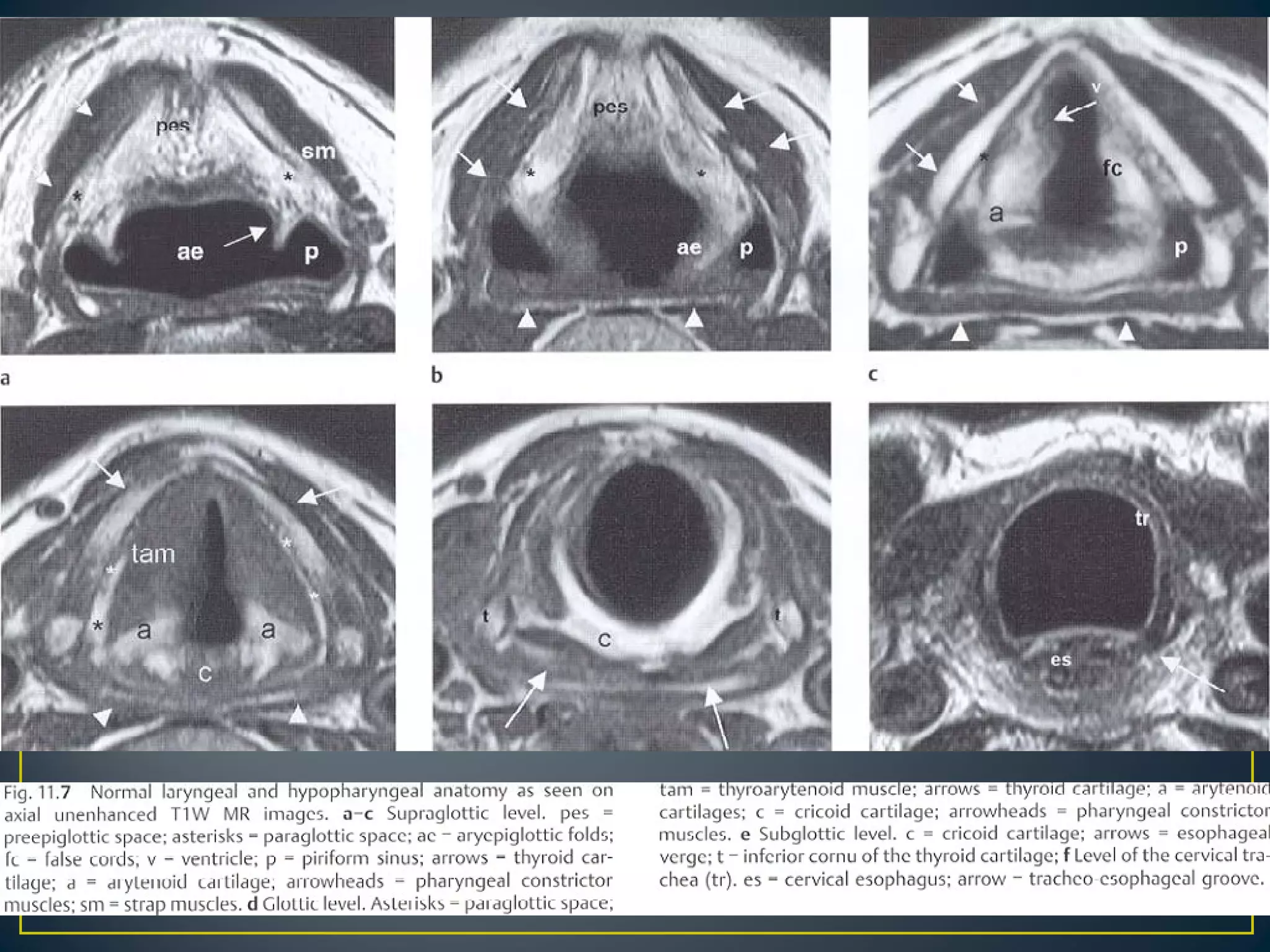 Larynx anatomy CT and MRI | PPT