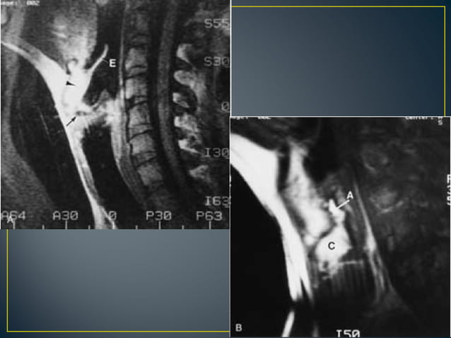 Larynx anatomy CT and MRI | PPT