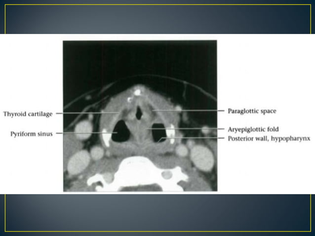 Larynx anatomy CT and MRI