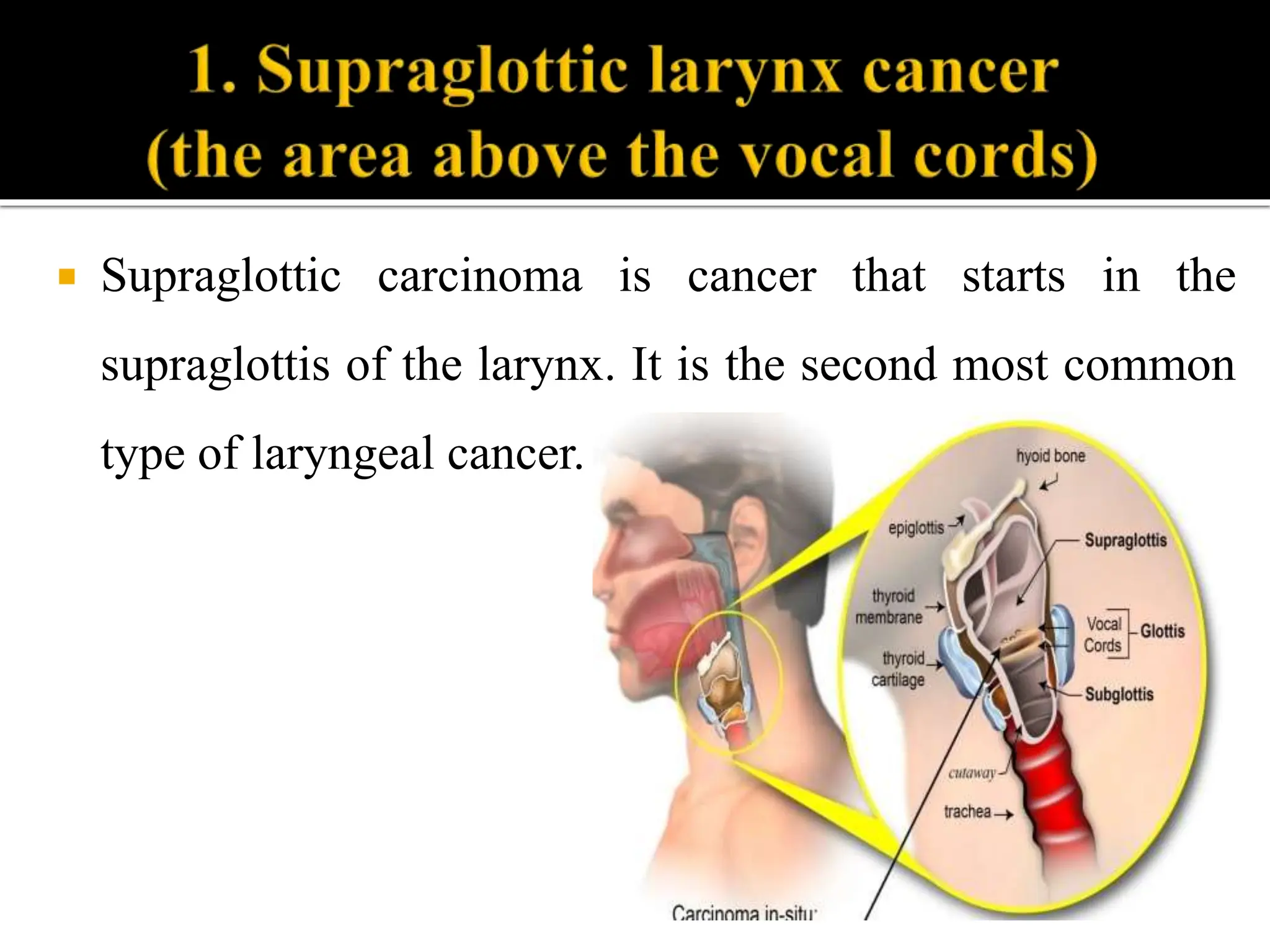 Larynx cancer.pptx