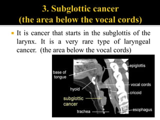 Larynx cancer.pptx