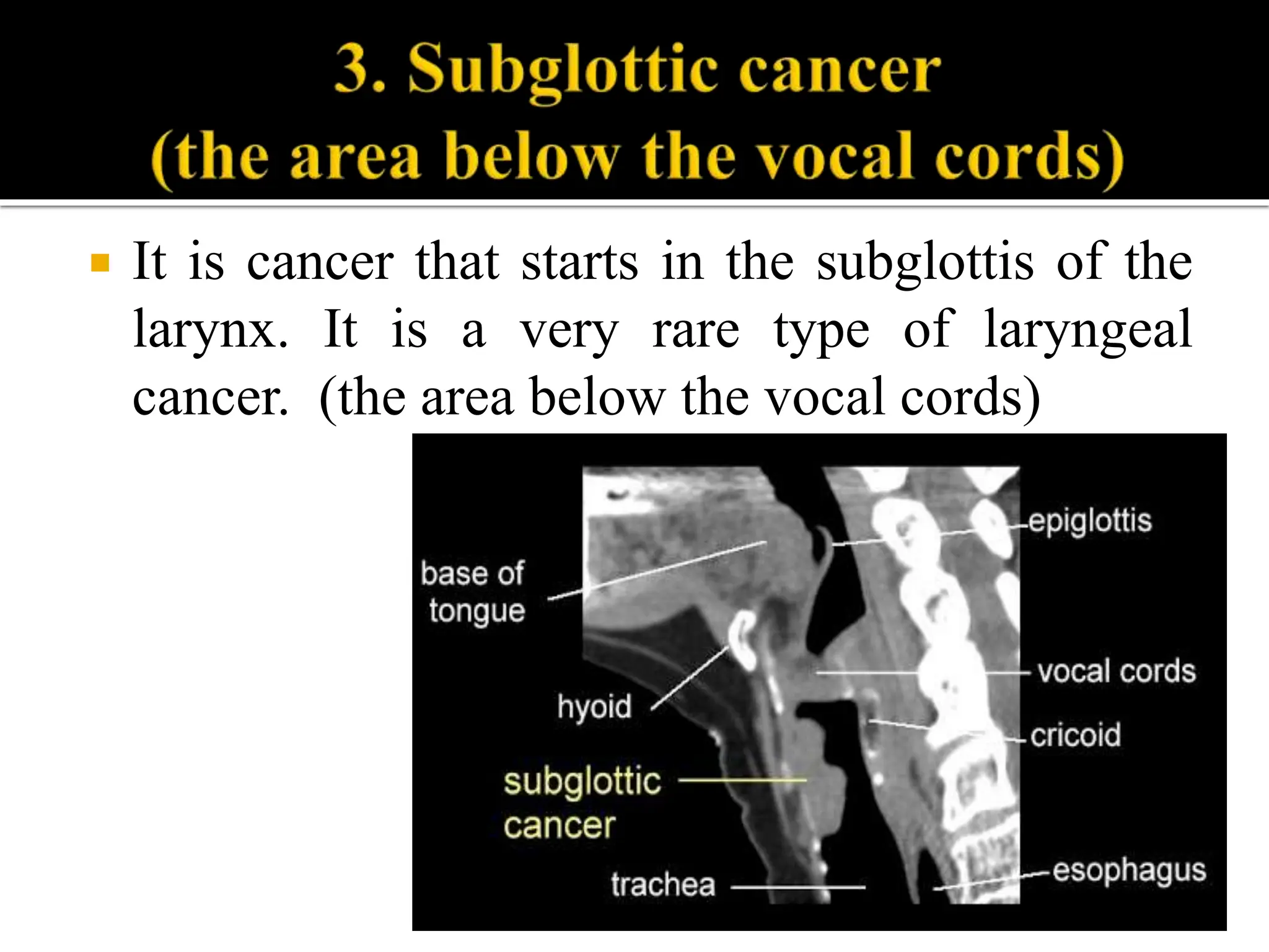 Larynx cancer.pptx
