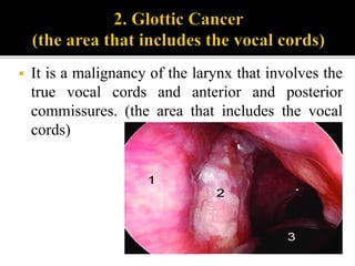 Larynx cancer.pptx