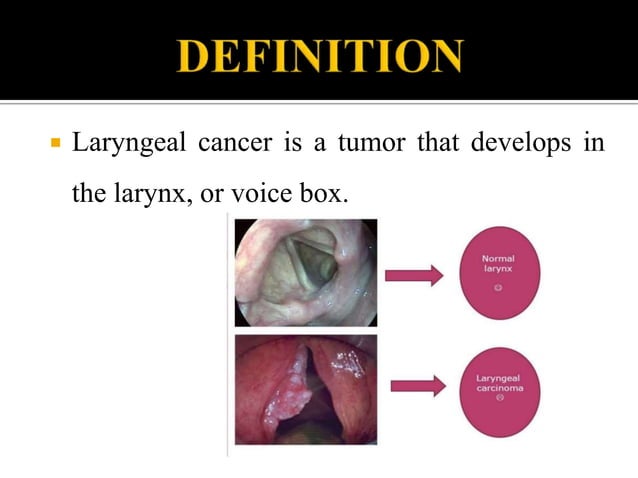 Larynx cancer.pptx