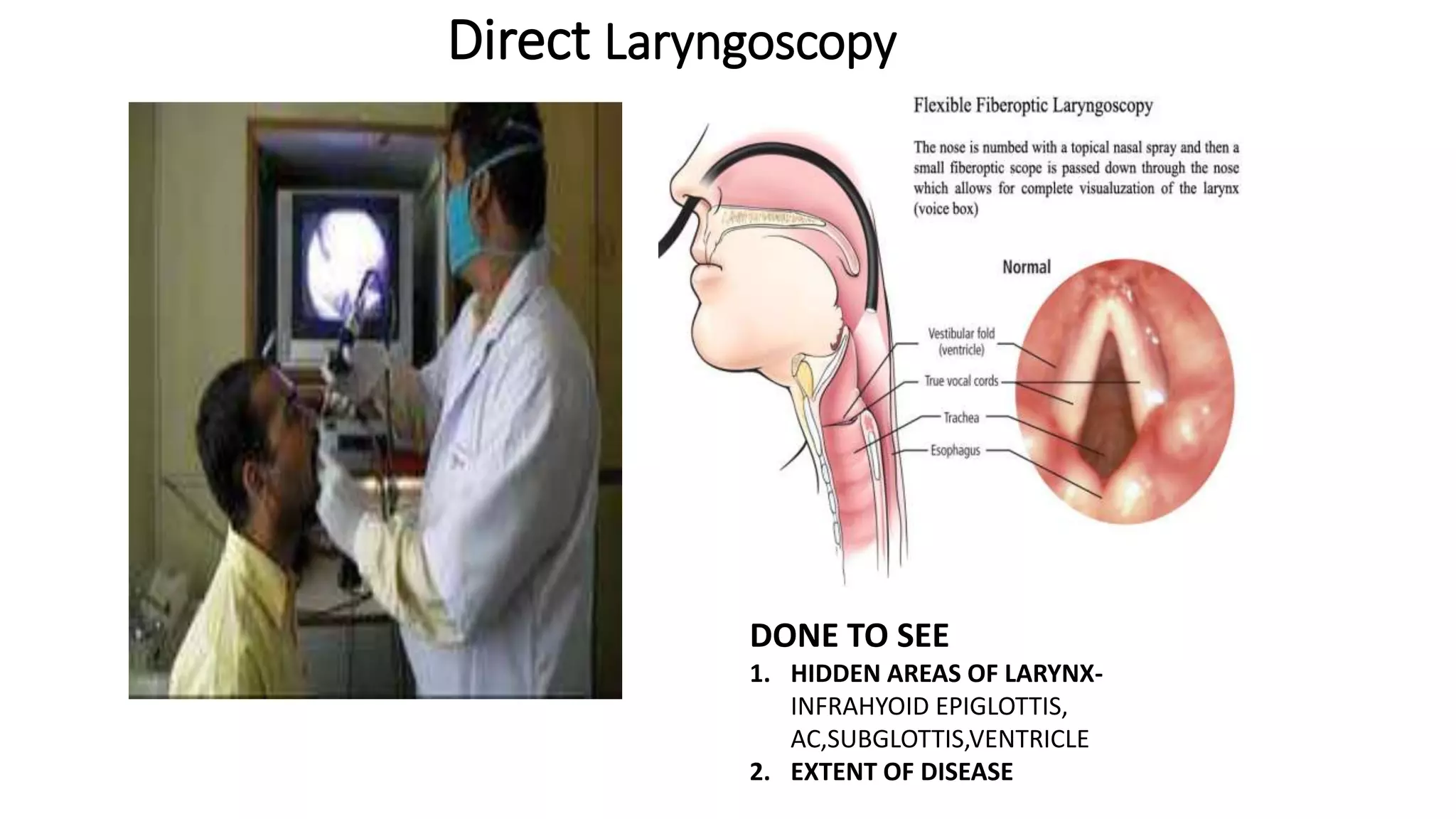 larynx anatomy, radiology and diagnostic work up.pptx | Thyroid ...