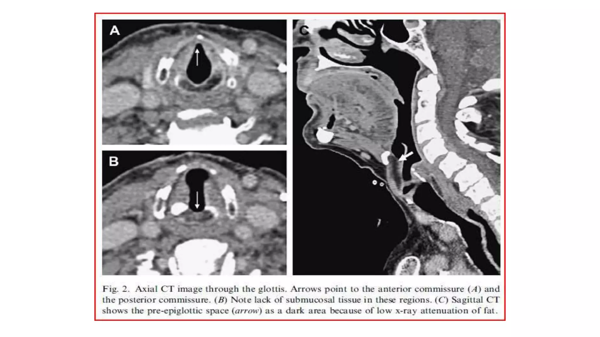 larynx anatomy, radiology and diagnostic work up.pptx