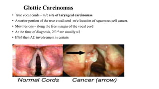 larynx anatomy, radiology and diagnostic work up.pptx