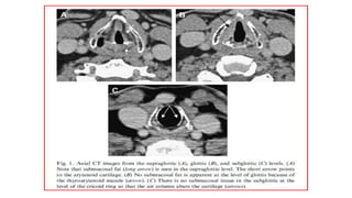 larynx anatomy, radiology and diagnostic work up.pptx