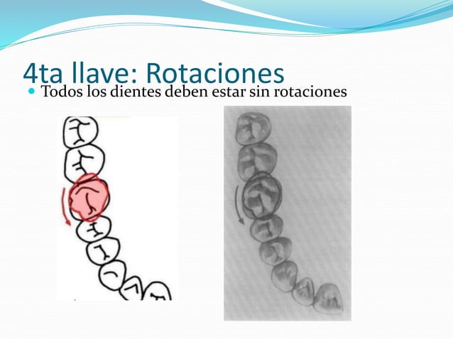 Las 6 llaves de la oclusión normal - andrews