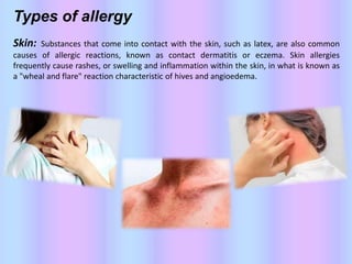 The allergies | PPTX