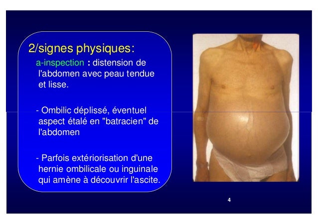 Ascite Pr arbaoui fac med Tlemcen