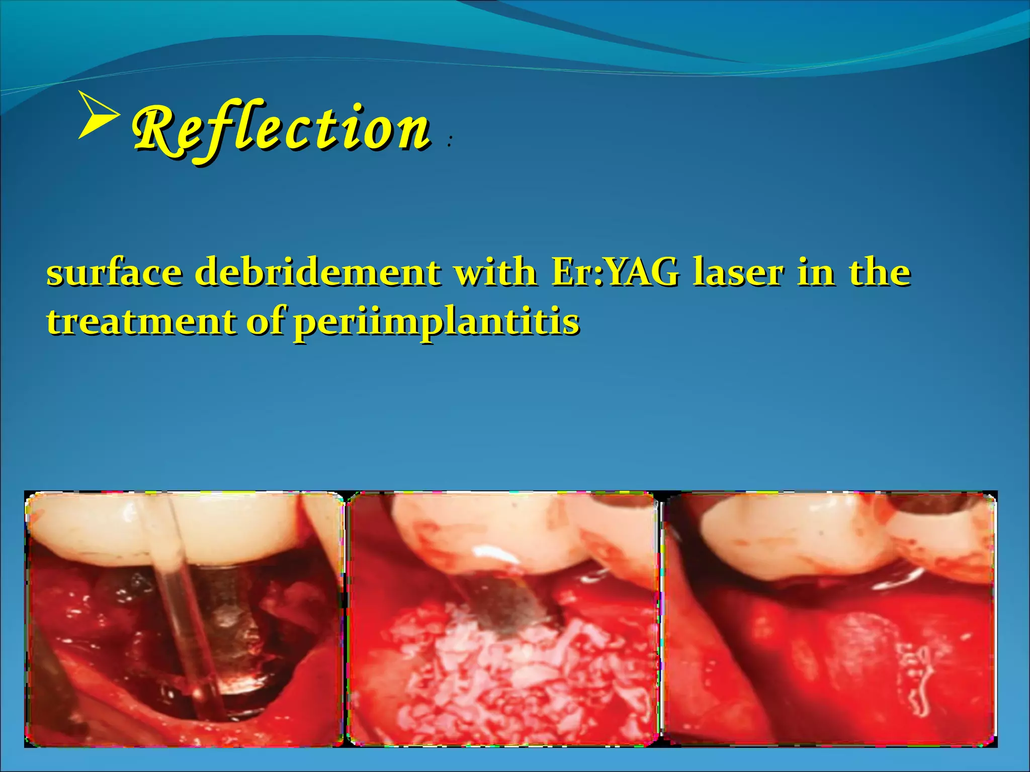 Laser Dental Hard Tissue Interaction With Possible Applications 2 Ppt