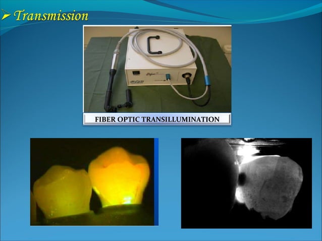 Laser Dental Hard Tissue Interaction With Possible Applications 2 Ppt
