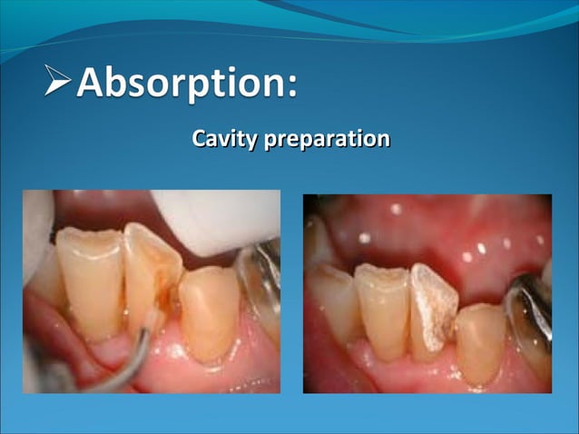 Laser Dental Hard Tissue Interaction With Possible Applications 2 Ppt
