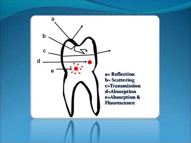 Laser Dental Hard Tissue Interaction With Possible Applications 2
