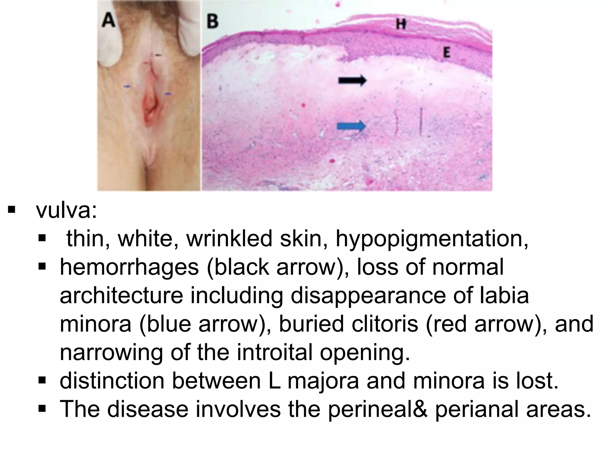 NEW USES OF LASER IN GYNECOLOGY | PDF